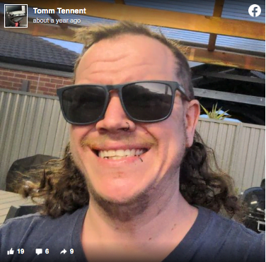 Tomm Tennent: The unique baby born with enough skin to cover the body ...