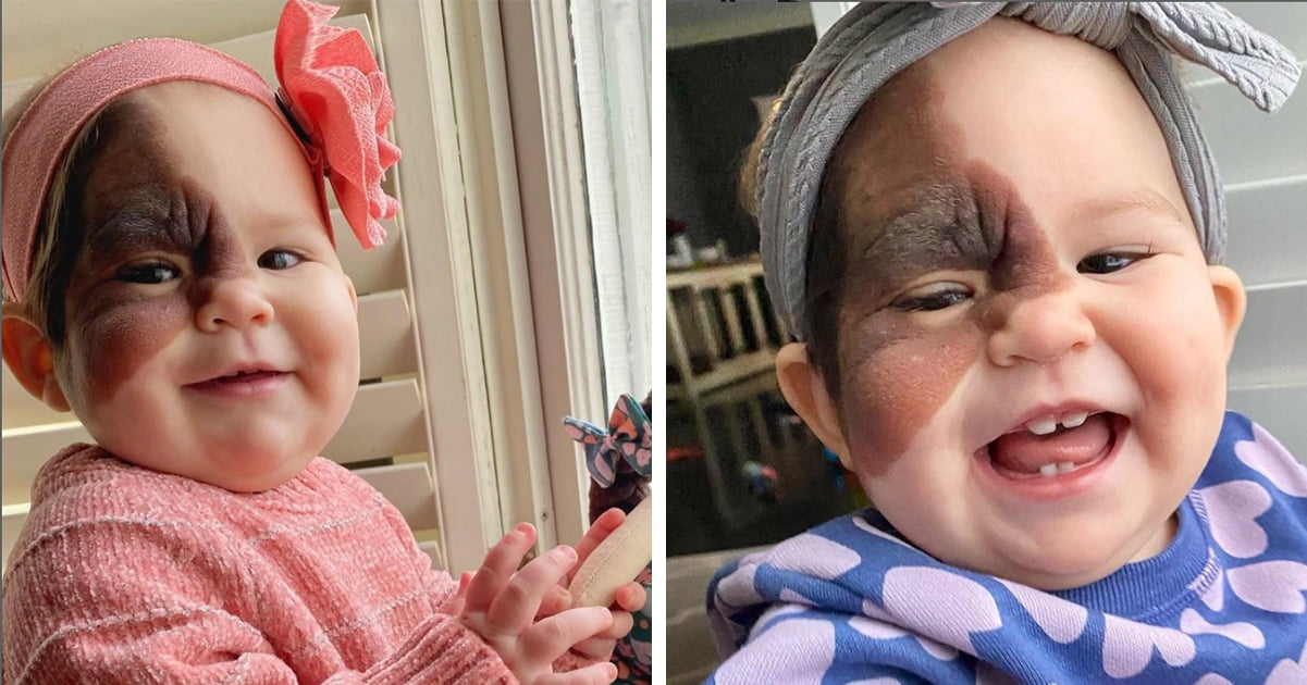Mom on a mission to show daughter with extremely rare birthmark that ...