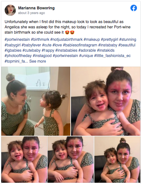 Baby With Red Birthmark Called ‘Hideous’ And ‘Defective’, But Wait Till ...