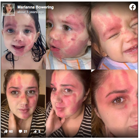 Baby With Red Birthmark Called ‘Hideous’ And ‘Defective’, But Wait Till ...