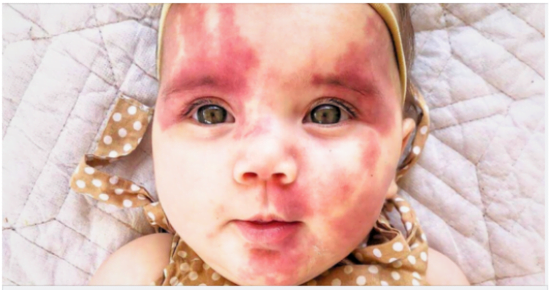 Baby With Red Birthmark Called ‘Hideous’ And ‘Defective’, But Wait Till ...